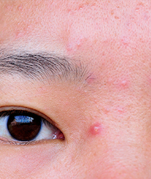 An unbalanced microbiome on the face may be key to acne development ...